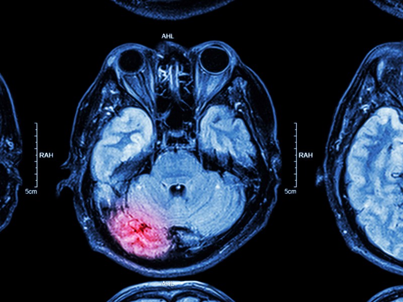 5 steps to speed recovery from concussions and traumatic brain injury ...